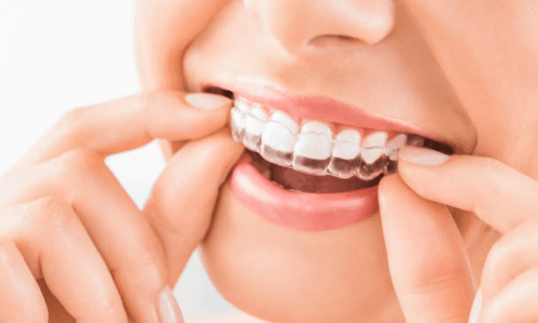 7 Tips To Prevent Tooth Stains While Wearing Clear Braces